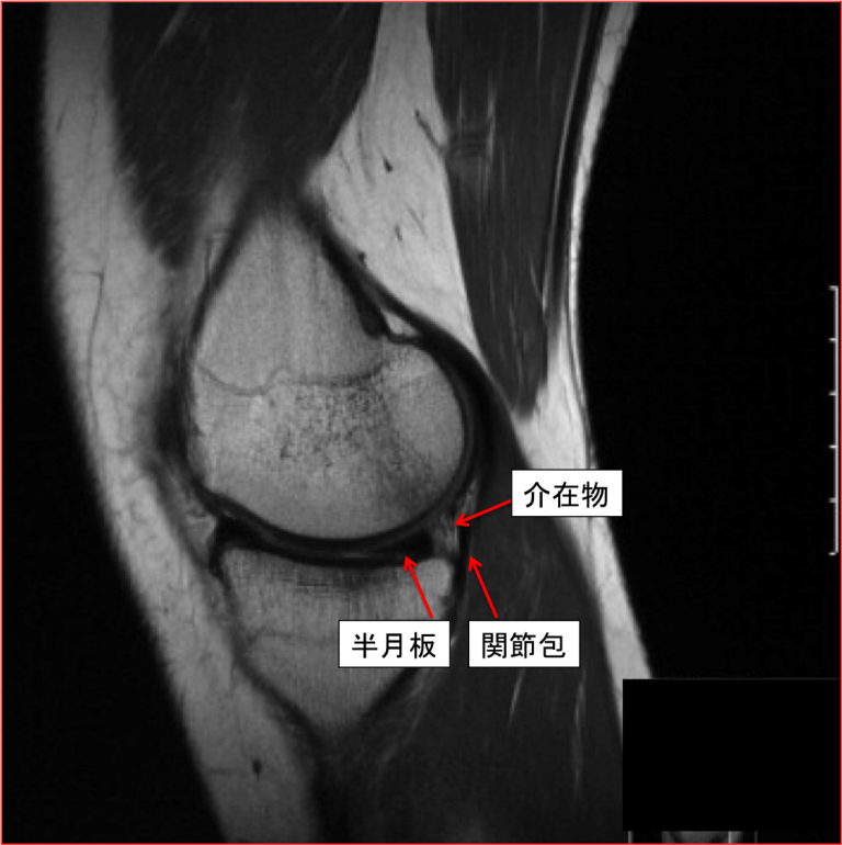 「meniscocapsular separation」とは？目指せスポーツドクター