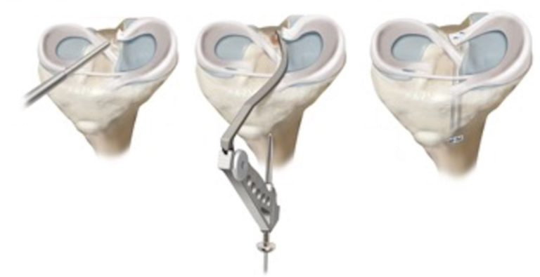 内側半月板後根断裂（MMPRT）の手術方法 pull-out修復術｜pie-crusting techniqueも解説！ 目指せスポーツ ...